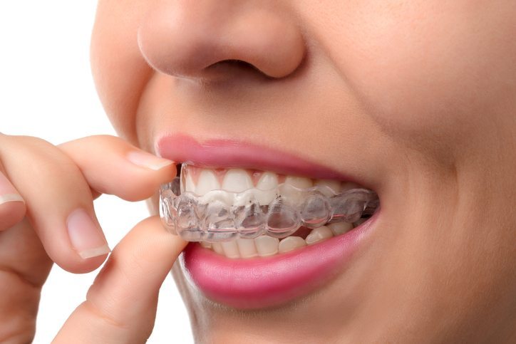 Why It’s Important to Wear Your Retainer